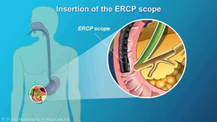 ERCP Endoscopy Treatment in Pune - Dr. Prasad Bhate